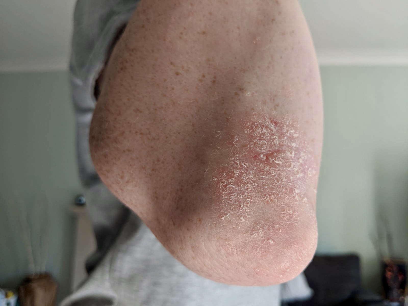 Psoriasis After a Baby - My Experience - Run Jump Scrap!